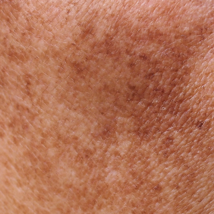 Hyperpigmentatie: alles over pigmentvlekken en hoe je ze kwijtraakt │ met BABOR